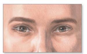 Squint your eyes - why one squints, convergent strabismus: code ...