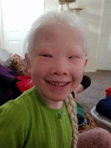 Albinism in humans - causes and how it is inherited