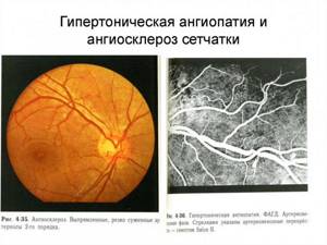 Atherosclerosis of retinal vessels - treatment and prognosis for recovery