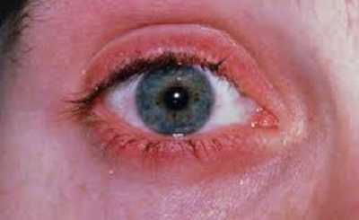 Meibomian blepharitis - what is it, symptoms and treatment
