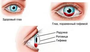 Hyphema of the eye: treatment of hemorrhage in the anterior chamber ...