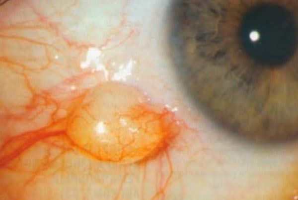Types of dermoid cysts in humans: methods of treatment and diagnosis