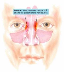 Pain in the bridge of the nose and eyes without runny nose