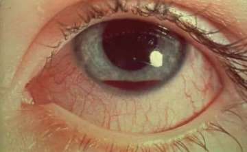 Hyphema of the eye: treatment of hemorrhage in the anterior chamber ...