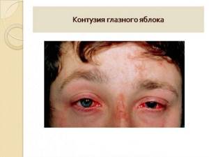 Hyphema of the eye: treatment of hemorrhage in the anterior chamber ...