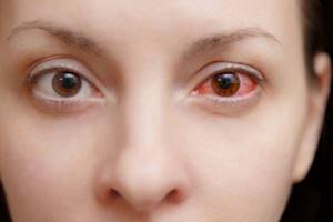 Eye mites in humans: treatment, symptoms, photos