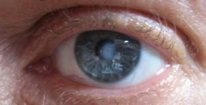 Clouding of the cornea of the eye (leukoma, cataract): understanding ...