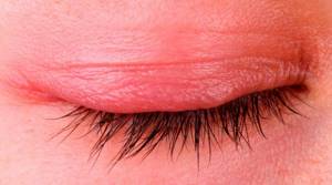 Meibomian blepharitis - what is it, symptoms and treatment