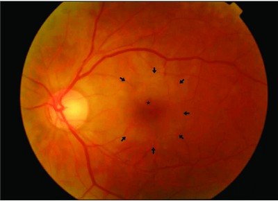 Macular edema of the retina: ? causes, symptoms, treatment, prognosis