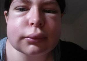 Quincke's edema: what it looks like, first aid at home