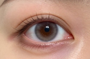 Hyphema of the eye: treatment of hemorrhage in the anterior chamber ...